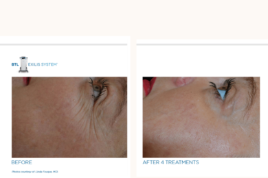 BTL Exilis Treatment | Dr. Kamil Al Rustom Skin & Laser Centre